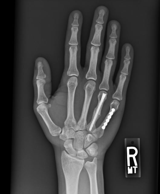 NX Nail fixation of fifth metacarpal fracture involving distal diaphysis with comminution.